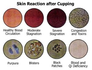 cupping color chart - TCM Tips