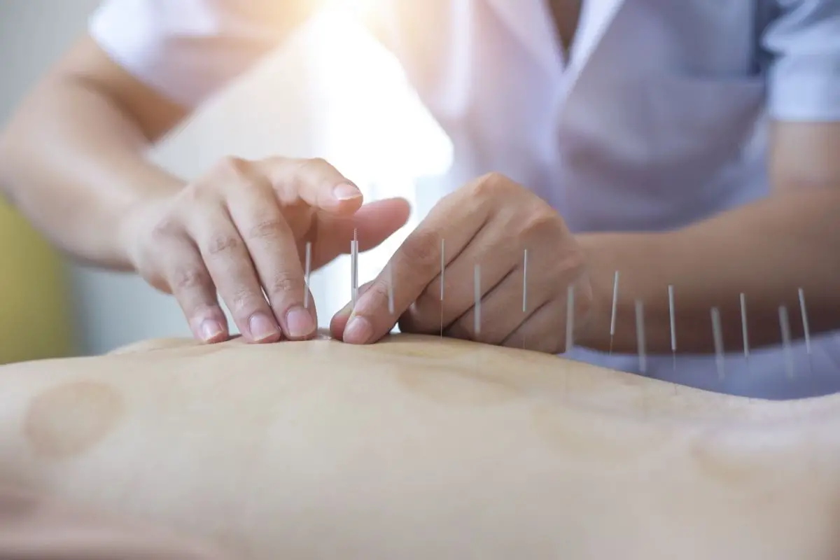 Acupuncture Places In Indianapolis - Easy TCM Wisdom : Your Path to DIY ...