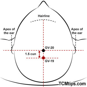 Best Tip Ever: Acupuncture For Alopecia Areata - TCM Tips